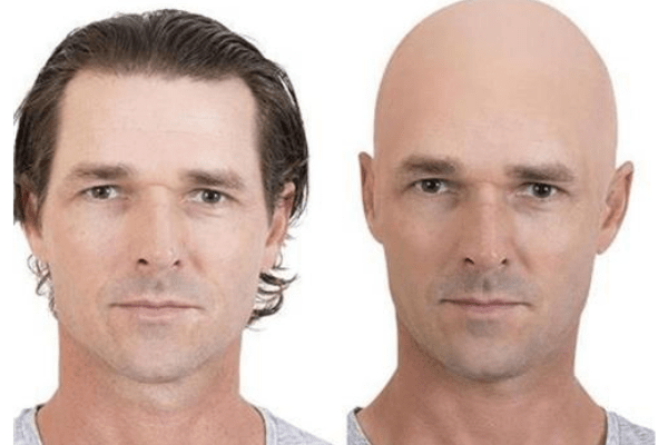 Descubra sua versão careca pelo aplicativo Grátis - Babado Digital